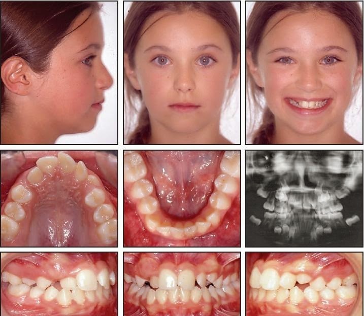 Simple Method for Aligning Retroclined or Ectopic Teeth | EURO DENTIST